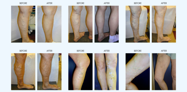 Leg Vein Clinic – Texas Surgical Association
